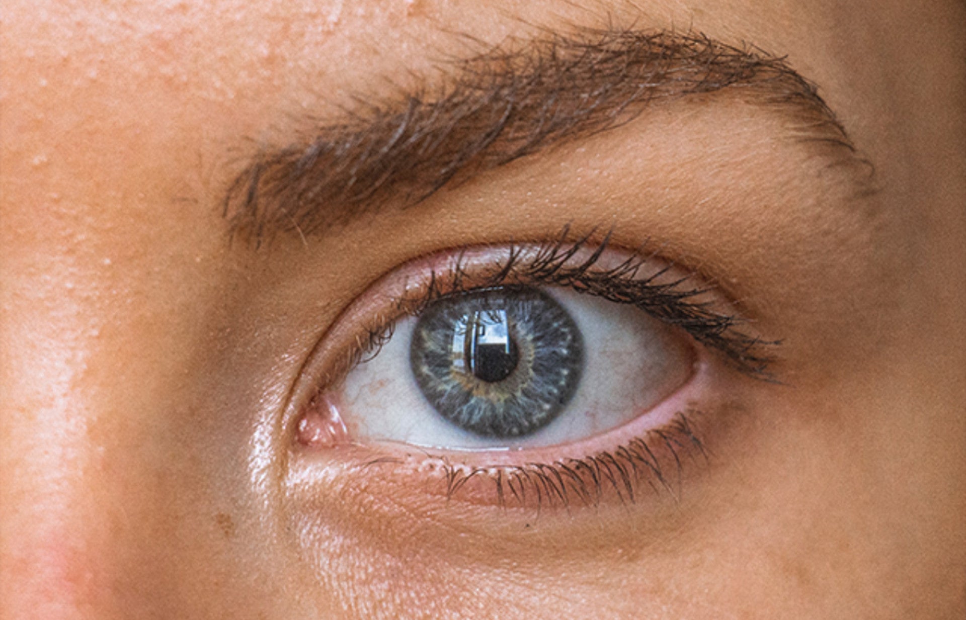 How To Get Rid Of Milia Under Eyes Causes Treatments Contours Rx how-to-get-rid-of-milia-under-eyes-causes-treatments-contours-rx