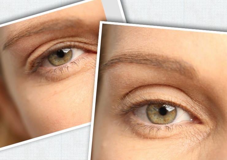 Before & After – Contours Rx